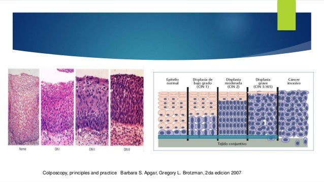 Lesión intraepitelial de alto grado LIEAG - Diagnostico y manejo - vph