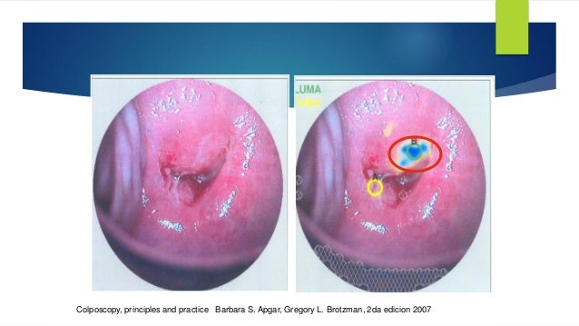 Lesión Intraepitelial De Alto Grado Lieag Diagnostico Y Manejo Vph