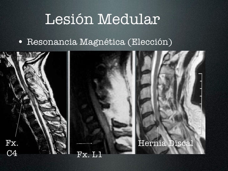 Lesión medular