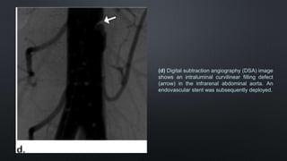 Lesión vascular en trauma abdominal cerrado kenny diaz.pptx