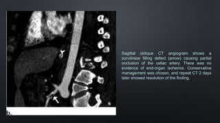 Lesión vascular en trauma abdominal cerrado kenny diaz.pptx