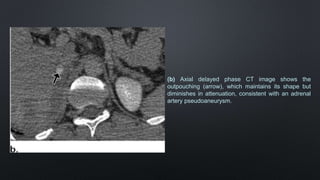Lesión vascular en trauma abdominal cerrado kenny diaz.pptx