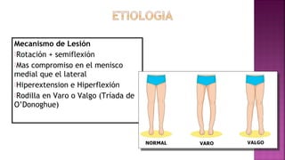 Lesion de-meniscos | PPT