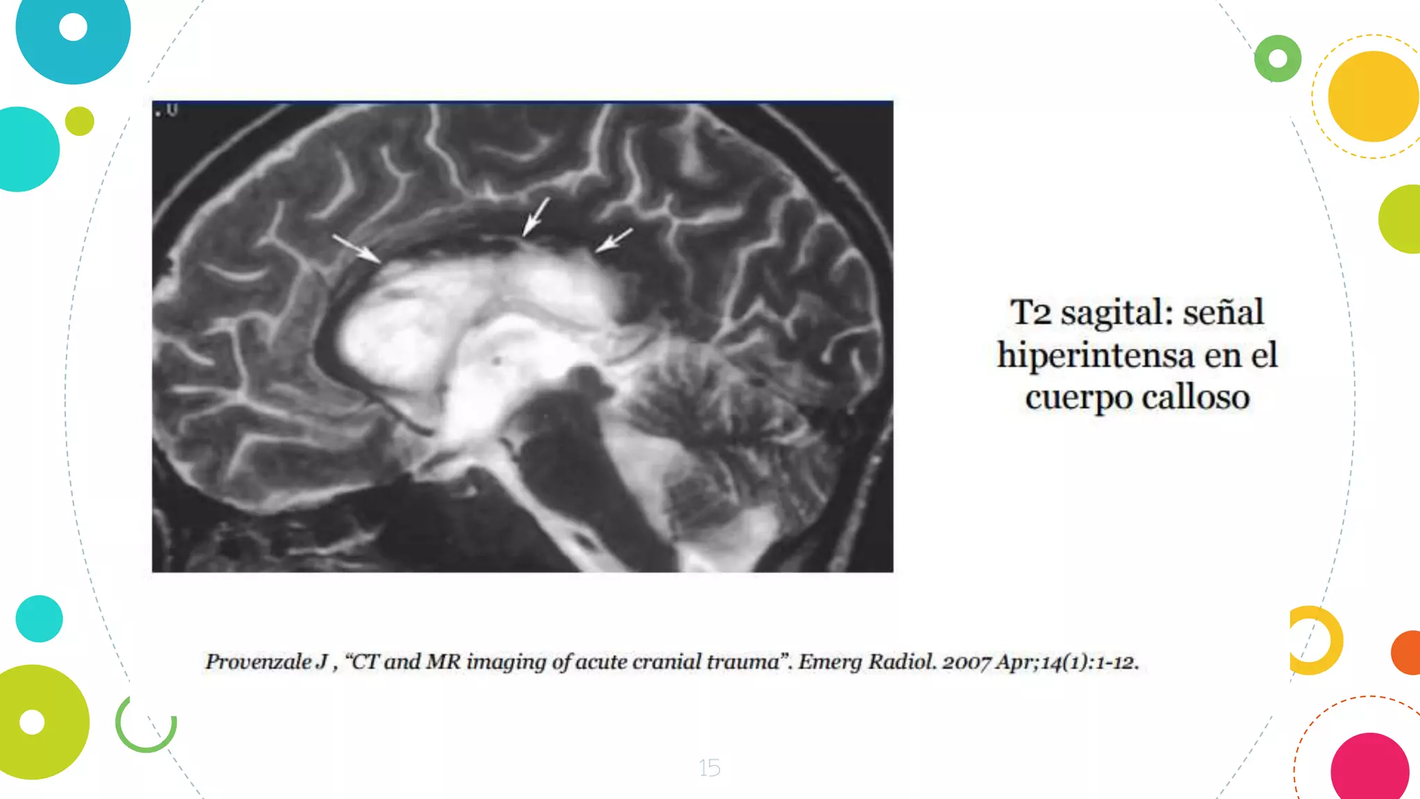 Lesion axonal difusa | PPTX