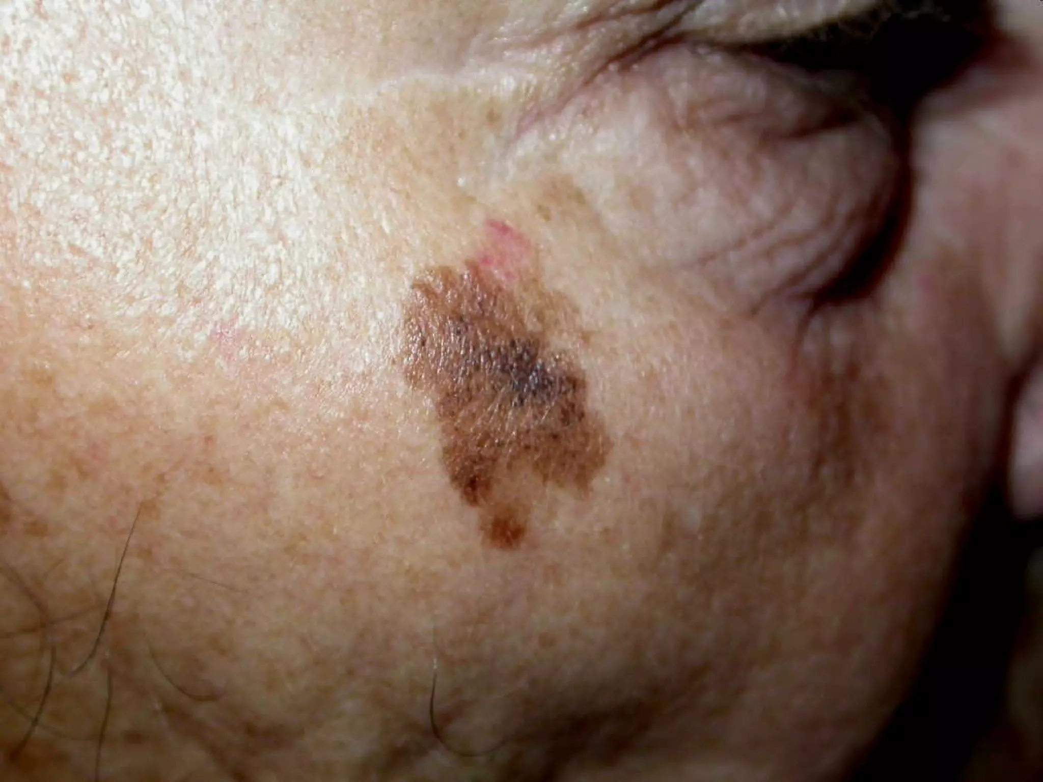 Lesion cheek | PPT