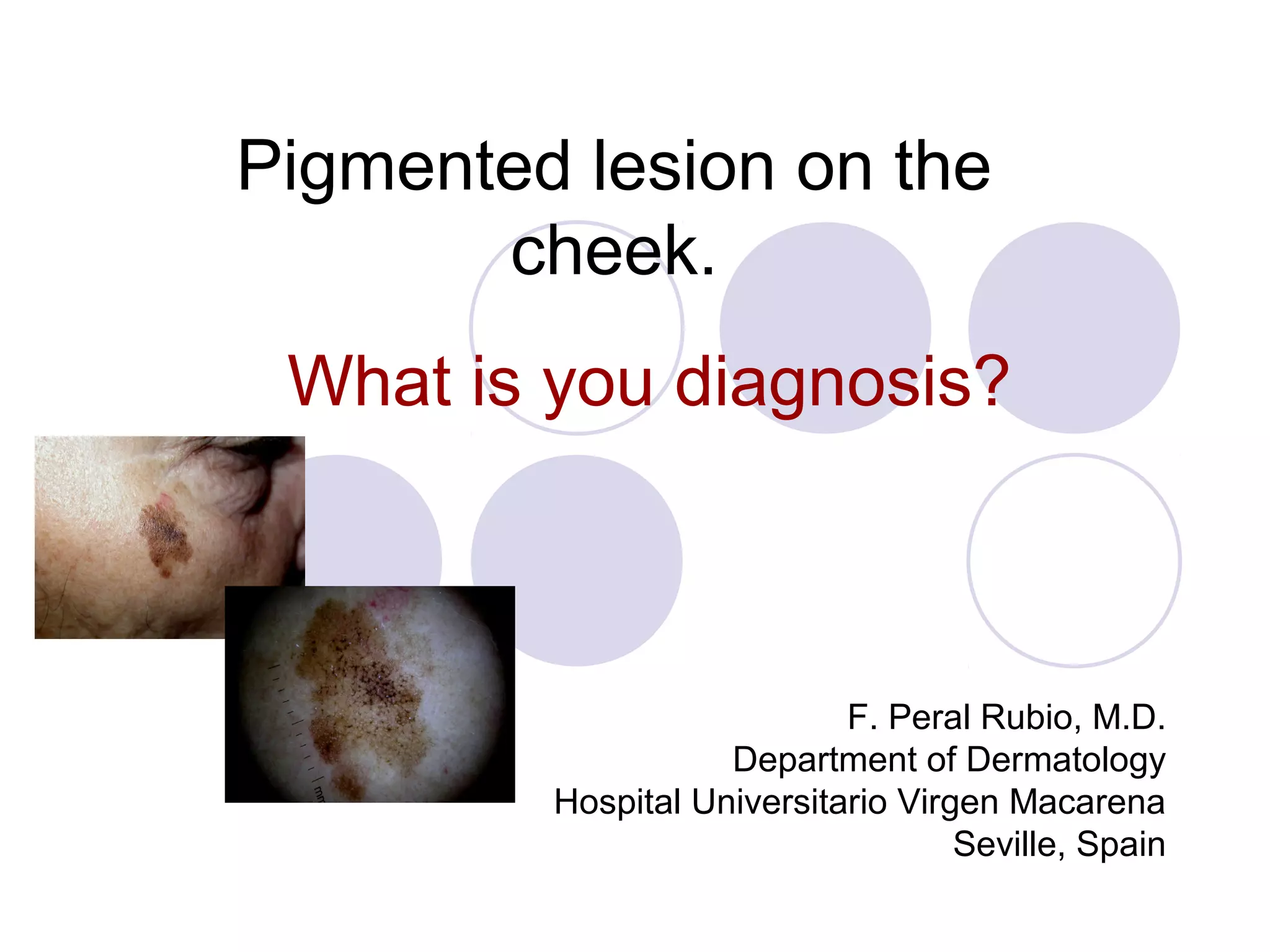 Lesion cheek | PPT