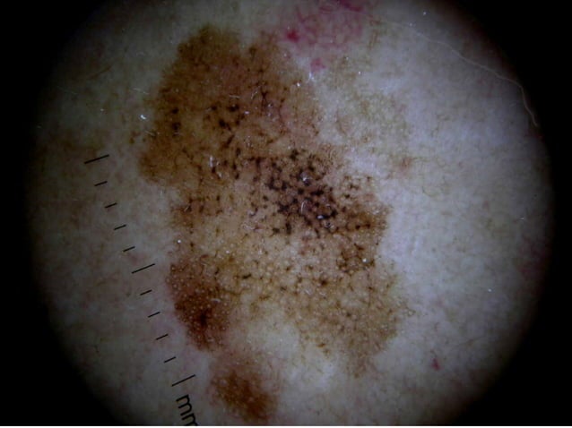 Lesion cheek | PPT