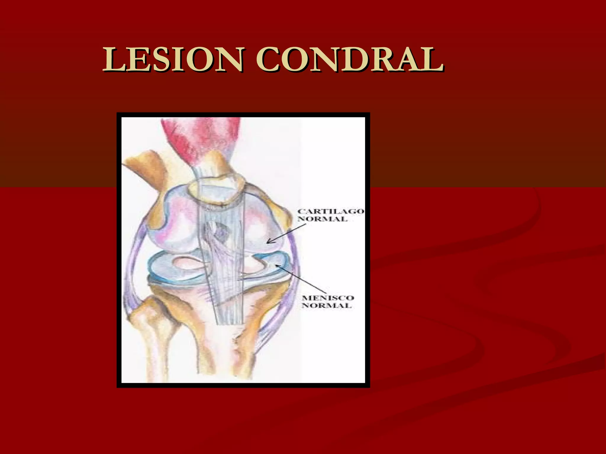 Lesion condral principios y clasificaciones | PPT