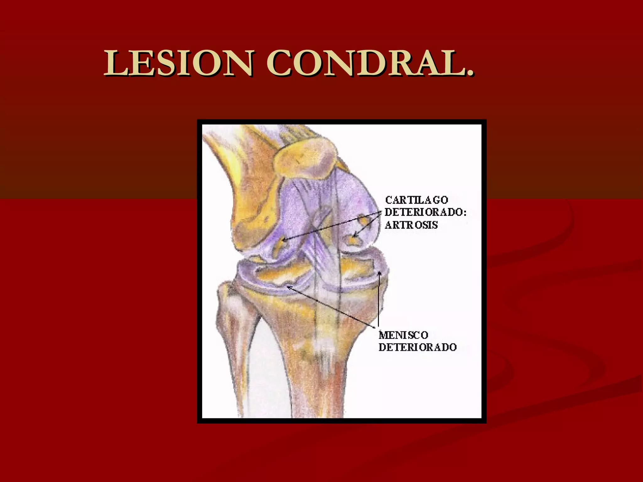 Lesion condral principios y clasificaciones | PPT