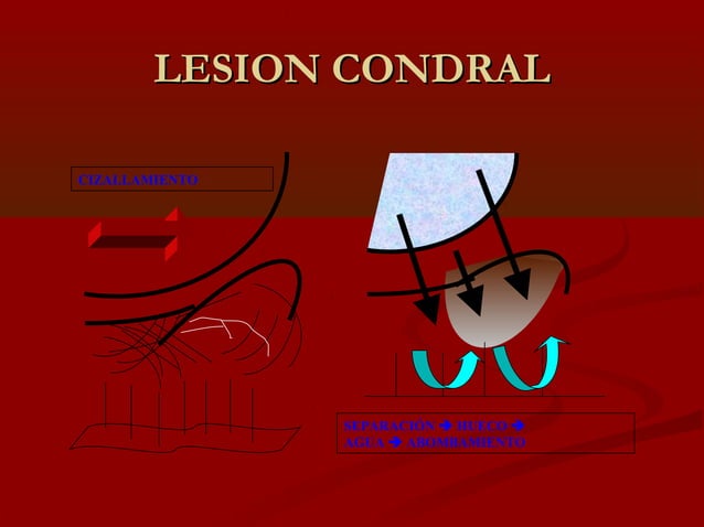 Lesion condral principios y clasificaciones | PPT