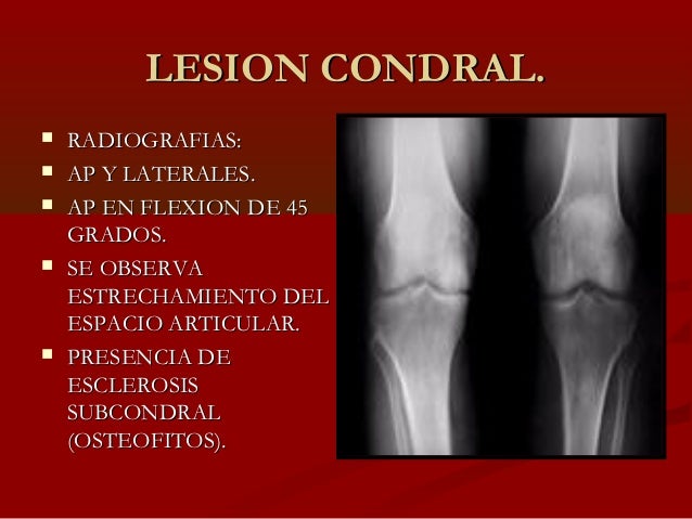 Lesion condral principios y clasificaciones