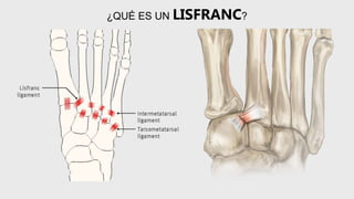 Lesion de LISFRANC, manejo diagnóstico y tratamiento | PPTX