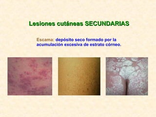 Lesiones E Infecciones De La Piel | PPT