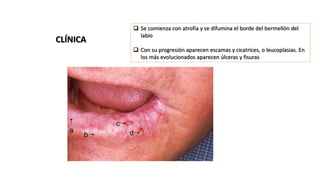 Lesiones Premalignas 1 Pptx