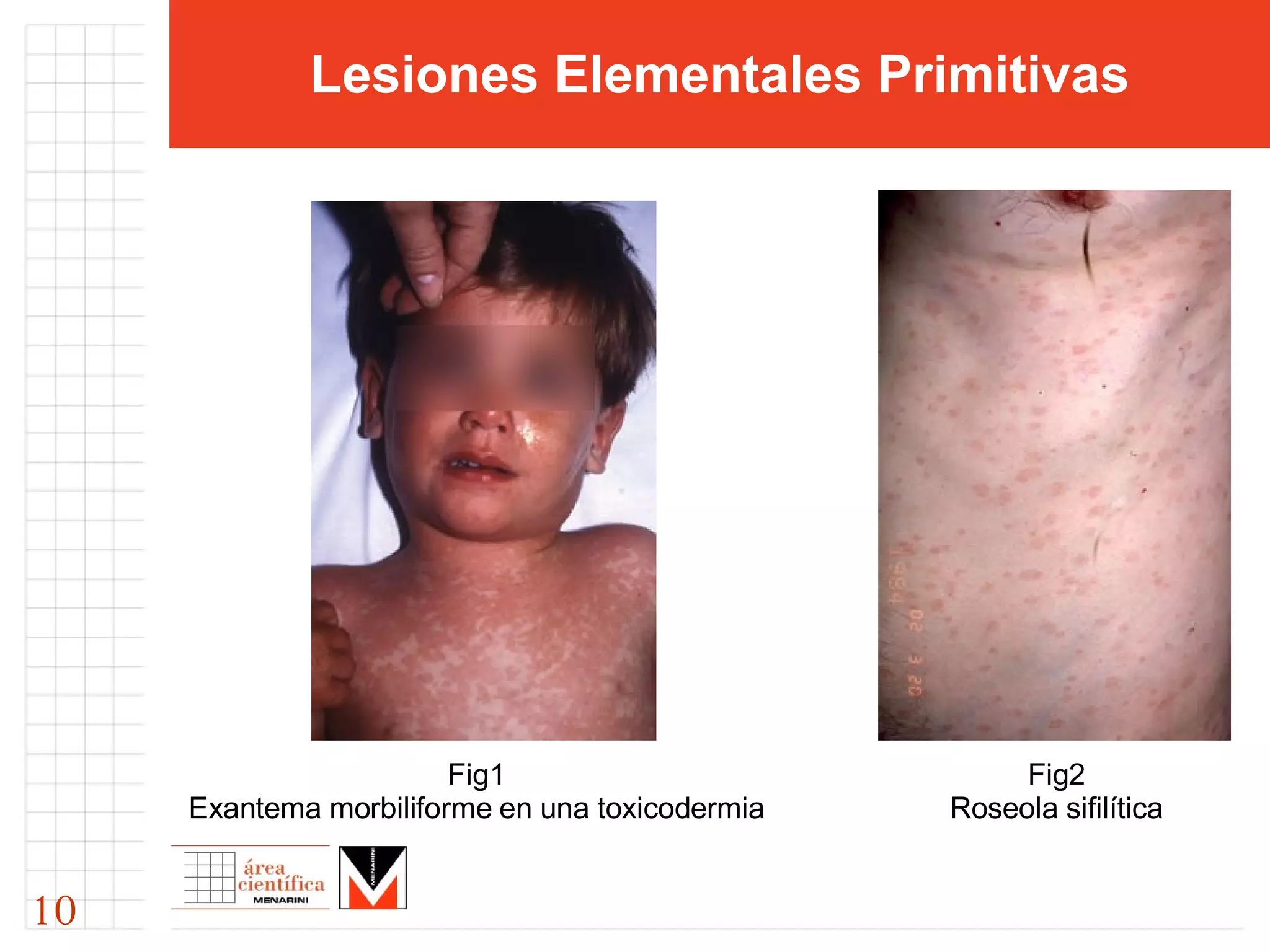 lesiones elementales dermatologia | PPS