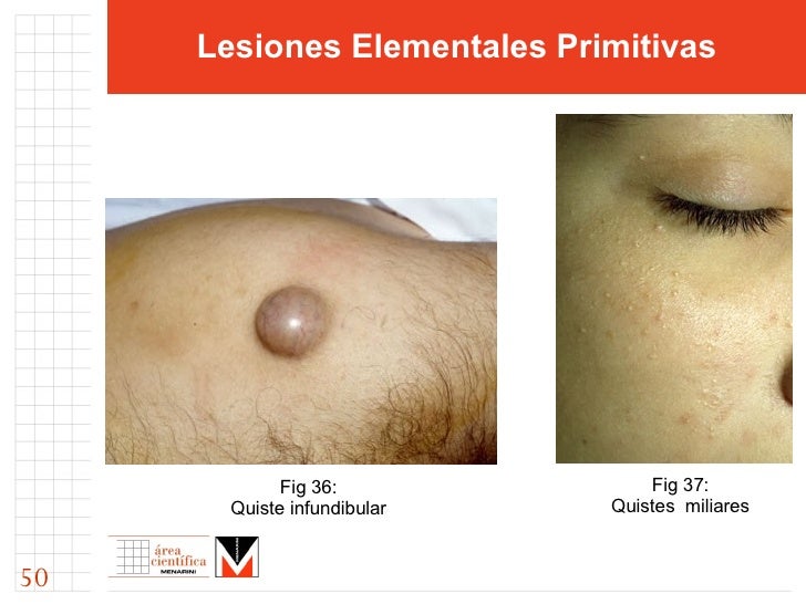 lesiones elementales dermatologia