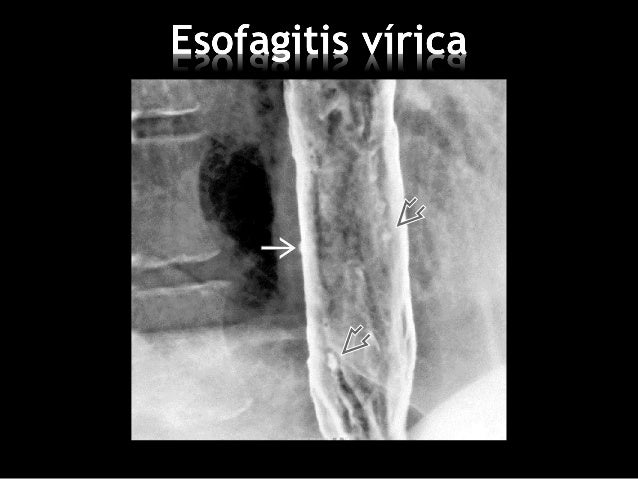 Lesiones benignas del esófago