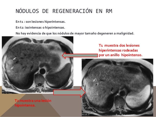 Lesiones benignas hepaticas