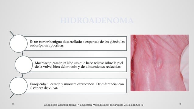 Lesiones_Benignas Vulva Dra. Kt Mrill ptx | PPTX | Medical Health