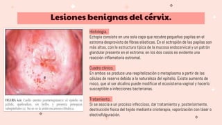 Lesiones beningas del cérvix e hiperplasia de endometrio. | PPTX