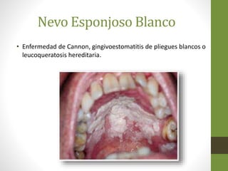 Nevus Esponjoso Blanco