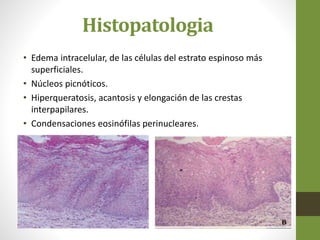Leucoedema