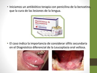 Leucoedema