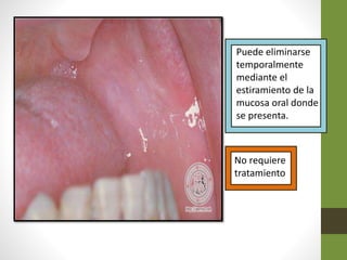 Leucoedema