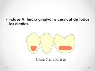 Lesiones cavitarias y clasificación de lesiones cariosas | PPTX