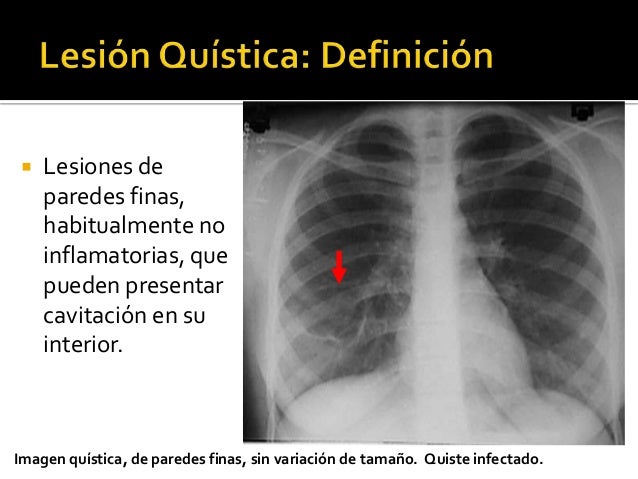 Enfisema Pulmonar Sintomas