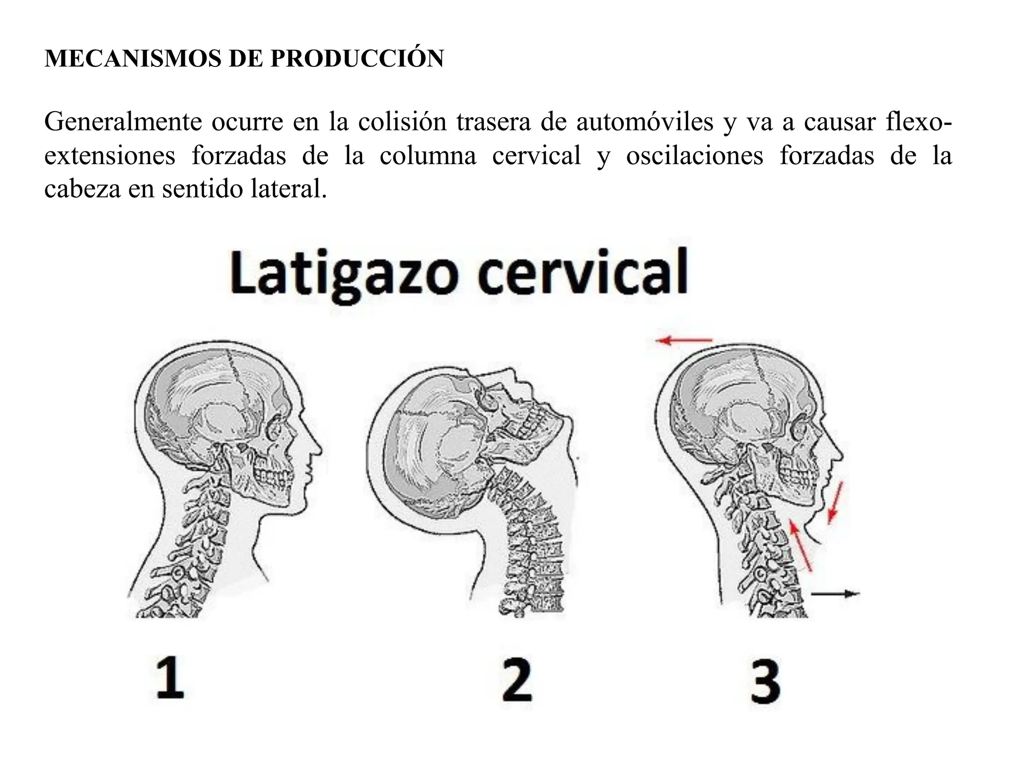 lesiones cervicales, sindrome de latigazo.pdf