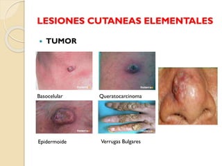 Lesiones cutaneas elementales. dermatologia. efrain negrete | PPTX