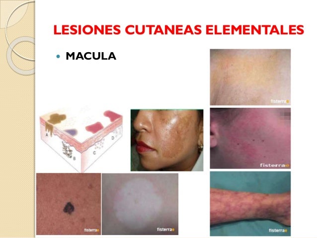 Lesiones Cutaneas