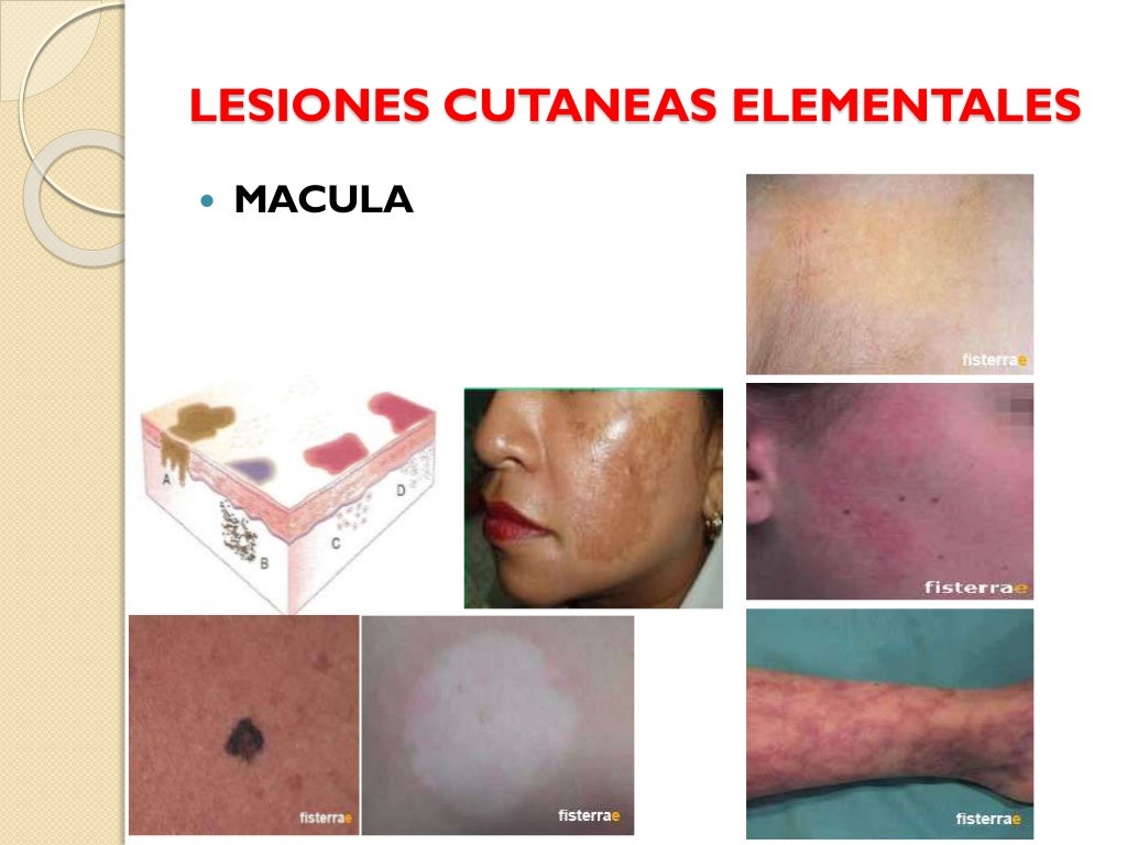 Lesiones cutaneas elementales. dermatologia. efrain negrete