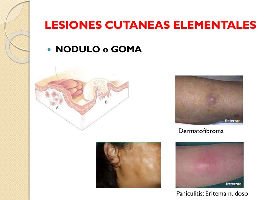 Lesiones cutaneas elementales. dermatologia. efrain negrete