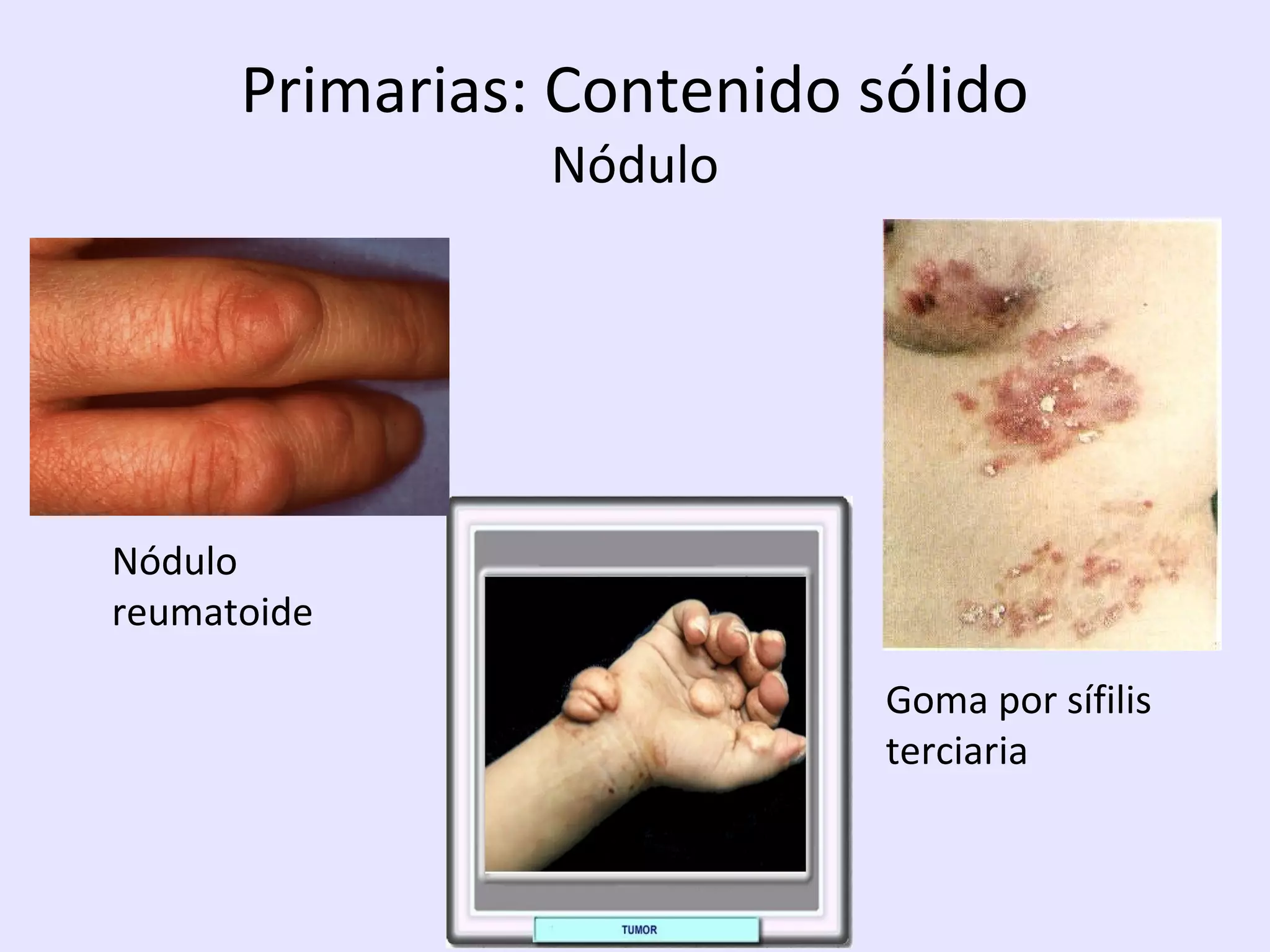 Lesiones cutaneas elementales | PPT