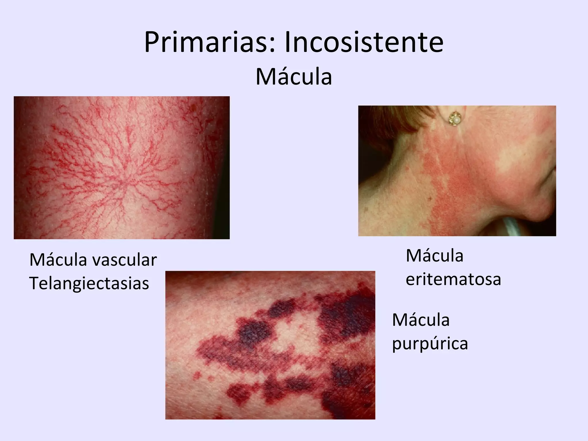 Lesiones cutaneas elementales | PPT | Skin and Dermatology | Diseases ...