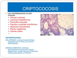 Lesiones cutaneas en pacientes VIH | PPTX