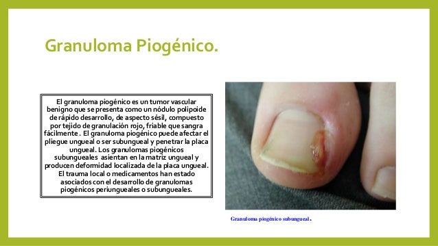 Lesiones del lecho ungueal