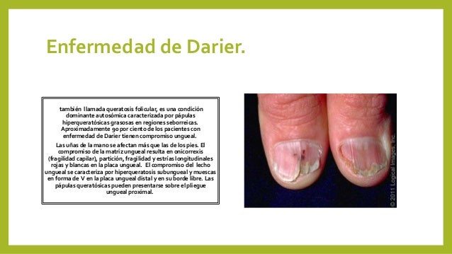 Lesiones del lecho ungueal