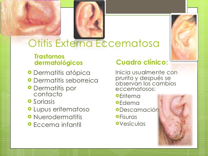 Lesiones del oido externo