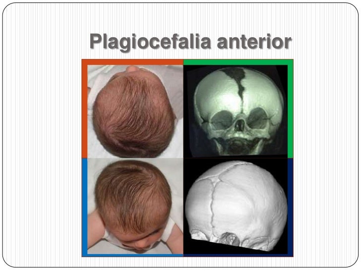 Lesiones de los huesos del craneo