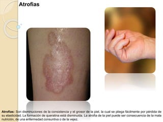 Lesiones de piel (primarias y secundarias) | PPT