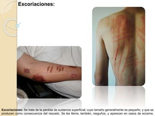 Lesiones de piel (primarias y secundarias) | PPT