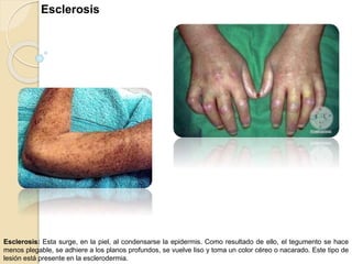 Lesiones de piel (primarias y secundarias) | PPT