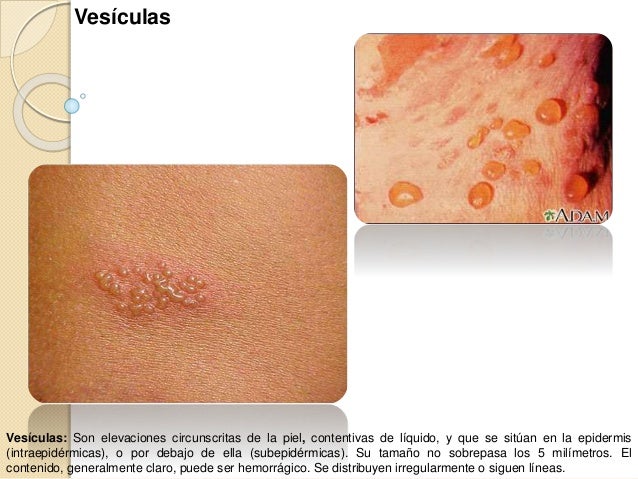 Lesiones de piel (primarias y secundarias)