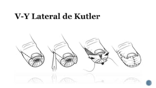 Lesiones de Pulpejo | PPTX