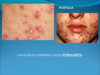 Lesiones dermatológicas básicas | PPT