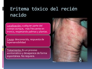 Eritema Tóxico Vs Melanose Pustulosa