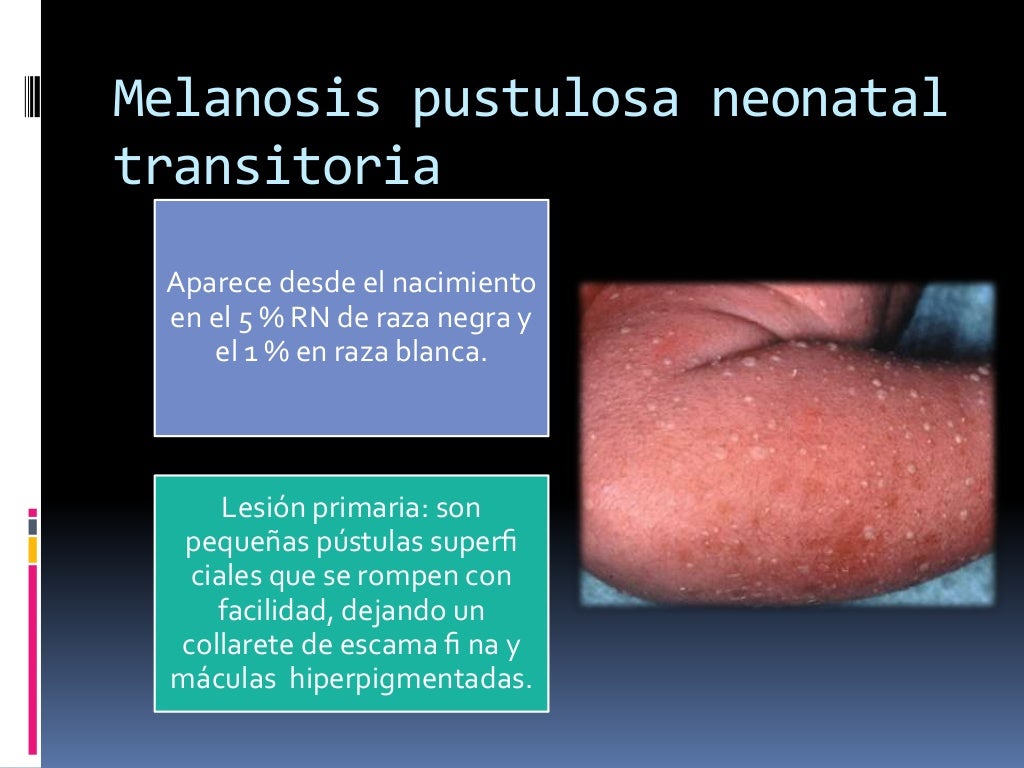 Lesiones dermatológicas del recién nacido sano